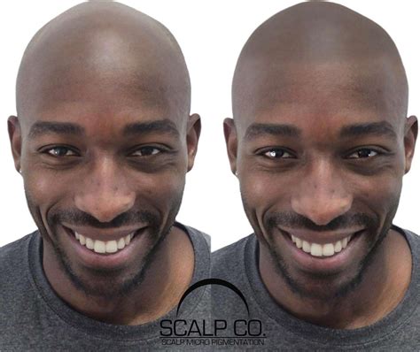 Scalp Micropigmentation What You Need To Know Self Tattoo