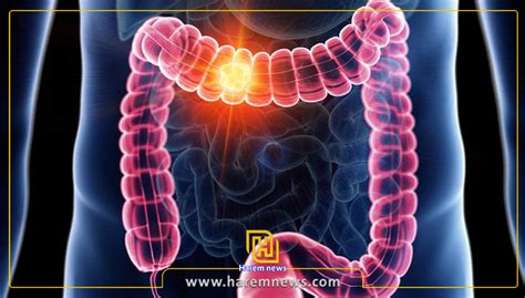 تەندروستی سلێمانی توشبوون بە شێرپەنجەی کۆڵۆن زیادی کردووە