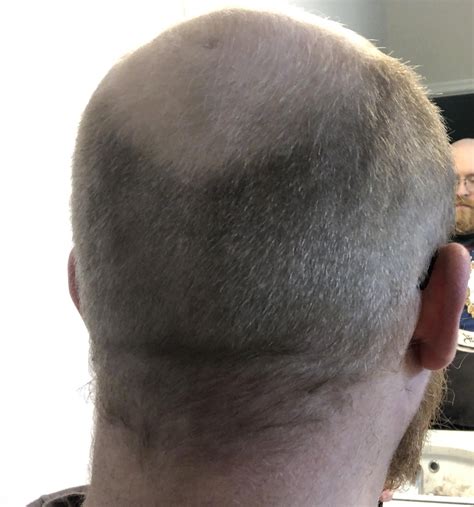 What Do You Think Only 18 And Fully Bald 🥲 Rbald