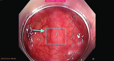 Computer Aided Detection Of A Polyp Reproduced With Permission From