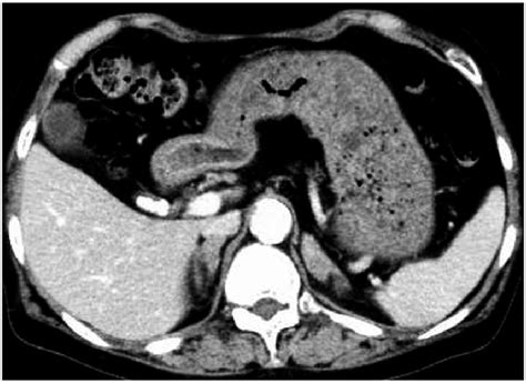Abdominal Contrast Enhanced Computed Tomography Ct The Image