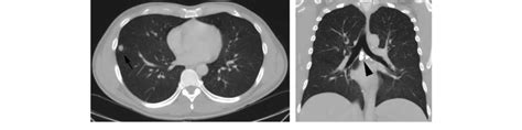 Chest Computerized Tomography Ct Scan With Contrast Showing Numerous Download Scientific
