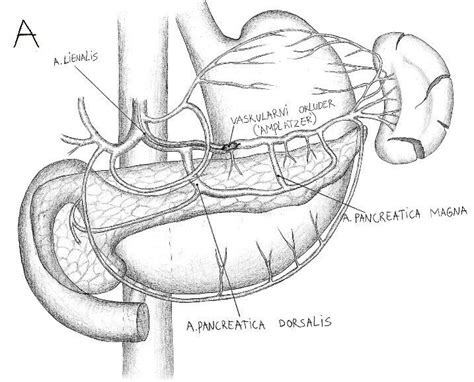 Proximal Splenic Artery Embolisation Download Scientific Diagram