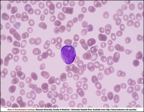 Acute Promyelocytic Leukaemia With Npm1 Rara Cell Atlas Of