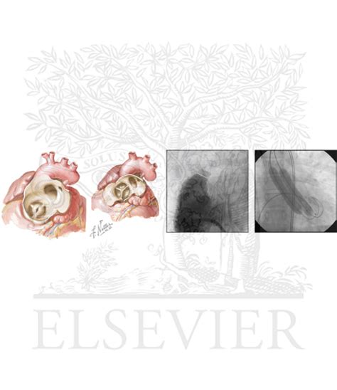 Congenital Aortic Valve Stenosis And Double Balloon Valvuloplasty