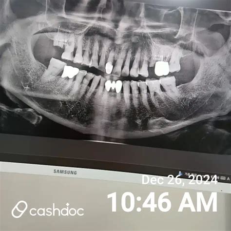 임플란트 치료 후기로서 느낀점에 대하여 캐시닥 커뮤니티
