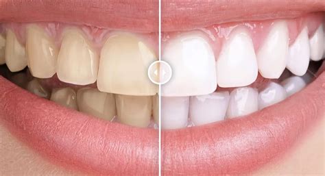 Before After Image Comparison Wp Plugin Ddgpl