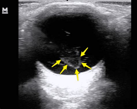 Vitreous Hemorrhage Ultrasound