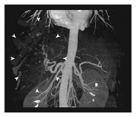 Multidetector Computed Tomography Mdct Images A Axial Mdct Image