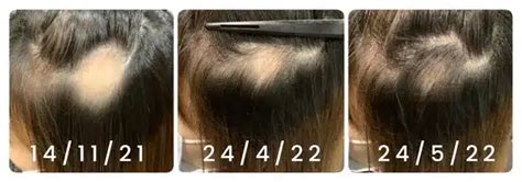 Hair And Scalp Specialist In Singapore Tricholab