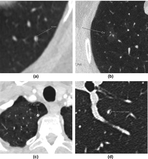 Clinical Evaluation Of A Deep Learning Based Computer Aided Detection