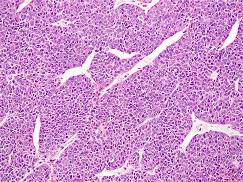 Pathology Outlines Glomus Tumor