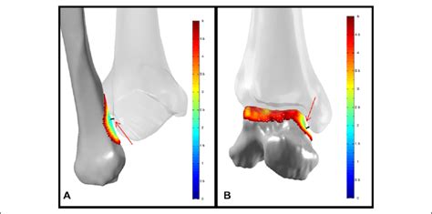 anatomical contour plot of bone spacing and identification of minimum download scientific