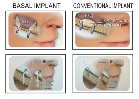 Sinus Lifts Or Sinus Bypass Dental Implant Speciality Centre
