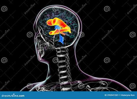 Enlarged Lateral Ventricles Of The Brain 3d Illustration