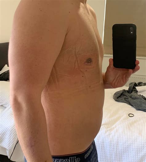 Experience With Kenalog Steroid Injection Post Surgery To Remove Scar Tissue R Gynecomastia