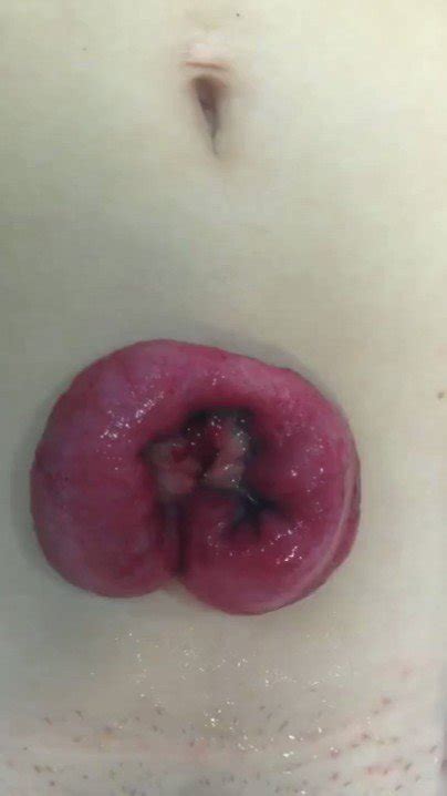 The Innovation Medicine On Twitter What Intestinal Peristalsis