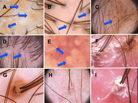 A Honeycomb Hyperpigmentation B Perifollicular Hyperpigmentation In