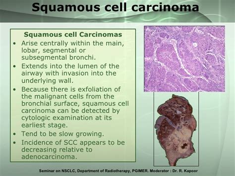 Non Small Cell Lung Cancer