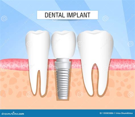 Parts Of Dental Implant Screw Diagram