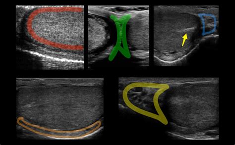 Small Parts Testicular Ultrasound Sonoguide