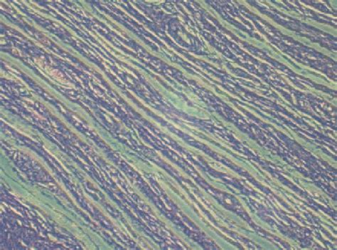 15 The Myometrium Surrounding Fibroid Produce A Sort Of Pseudocapsule Download Scientific