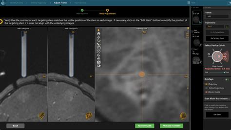 Smartframe Array Neuro Navigation System Clearpoint Neuro