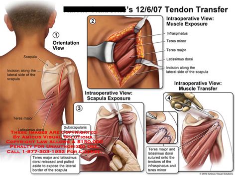 AMICUS Illustration Of Amicus Surgery Shoulder Tendon Transfer Teres