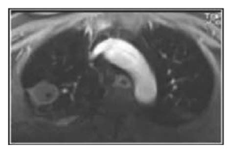 Mri Features Of Different Types Of Lung Nodules A Pulmonary Nodule