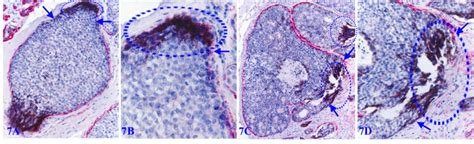 Her 2 Positive Cell Clusters Overlying Focally Disrupted Mecls