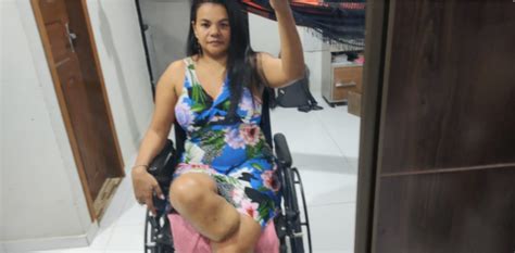Mulher que teve perna amputada pede ajuda para adquirir prótese Folha BV