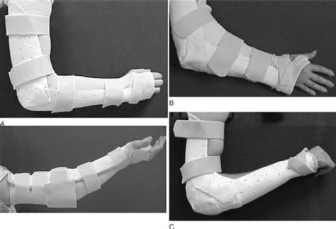 Progressive Splinting