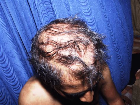 What Is Effective Scalp Psoriasis Treatment For Pregnant Women ResearchGate