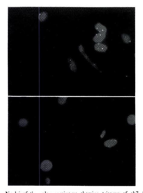 Figure 1 From Numerical Chromosomal Aberrations In Colorectal Carcinoma Detected By Fluorescence