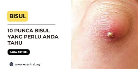 10 Punca Bisul Yang Perlu Anda Tahu