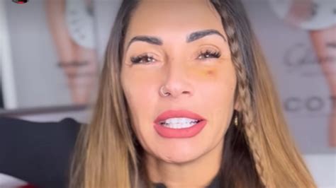 Uomini E Donne Incidente Domestico Per Ida Platano Cosa è Successo