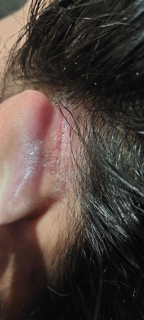 Behind Ears Issue R Sebderm