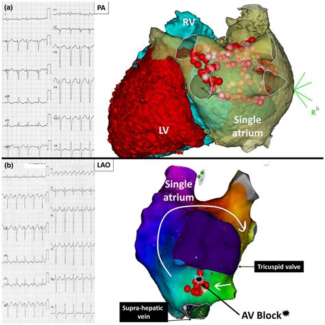 A Twelve‐lead Electrocardiogram During Atrial Fibrillation And