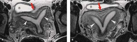 Genital Tract—ct Mr And Radiographic Imaging Radiology Key
