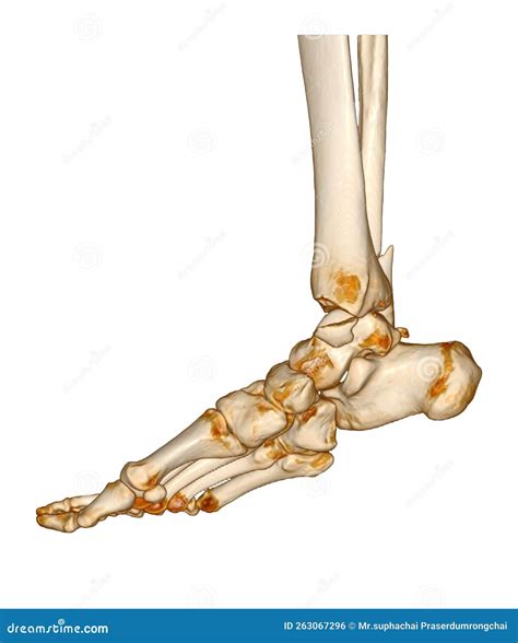 Ct Scan Ankle And Foot Or Computed Tomography Of Ankle Joint And Foot