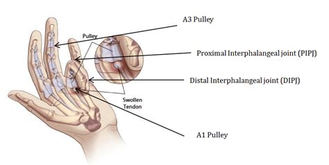Trigger Finger Causes Symptoms Treatment And Exercises Rebalance