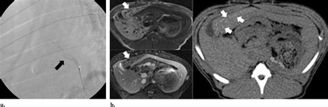 multimodal visibility of a modified polyzene f coated spherical embolic