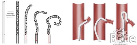 Computational Design Optimization Of Patient Specific Shape Morphing