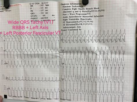 Fascicular Vt Left Posterior Fascicular Vt 38 Y M Well Palpitations… Dr Wasim Ahmed