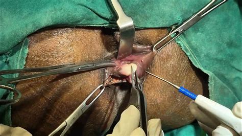 Fissurectomy With Fistulectomy Youtube