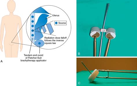 Principles Of Radiation Therapy And Chemotherapy In Gynecologic Cancer