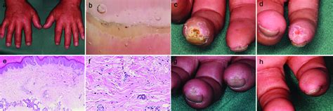 A Digital Oedema At The First Visit B Dermoscopic Findings Of Nail