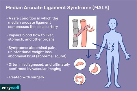 Mals Median Arcuate Ligament Syndrome