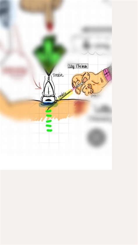 Ultrasound Guided Piv Example Training View In 2022 Ultrasound