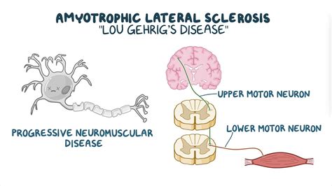 Video Amyotrophic Lateral Sclerosis Als Nursing